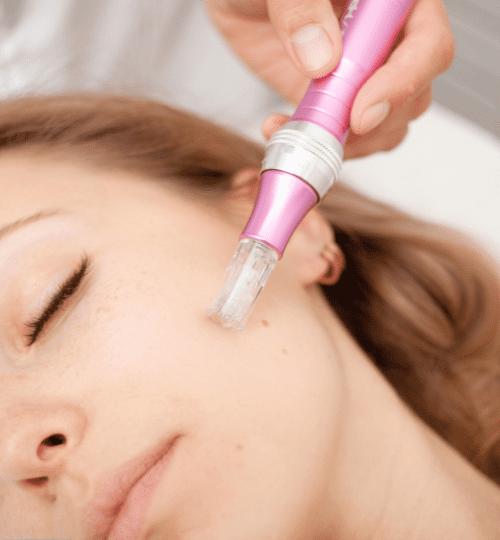 Nano Needling Chicago - Best in Skin Rejuvenation